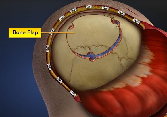 ΚΡΑΝΙΟΤΟΜΙΑ ΚΑΙ ΝΕΥΡΟΠΛΟΗΓΗΣΗ - Neurosurgery Dr. Stoforou - Δρ ...