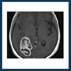 ΠΟΛΥΜΟΡΦΟ ΓΛΟΙΟΒΛΑΣΤΩΜΑ – ΝΕΕΣ ΘΕΡΑΠΕΙΕΣ - Neurosurgery Dr. Stoforou ...