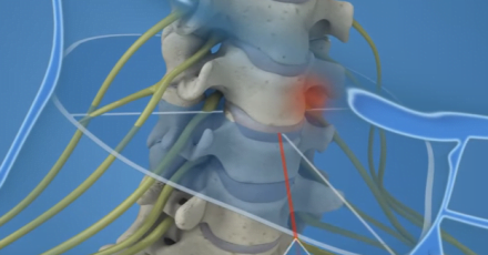 ΑΥΧΕΝΙΚΗ ΕΝΔΟΣΚΟΠΙΚΗ ΔΙΣΚΕΚΤΟΜΗ - NEUROSURGERYSTOFOROU