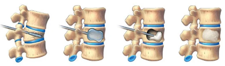 ΚΥΦΟΠΛΑΣΤΙΚΗ – ΣΠΟΝΔΥΛΟΠΛΑΣΤΙΚΗ - Neurosurgery Dr. Stoforou - Δρ ...