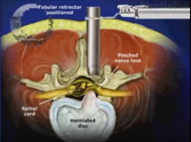 ΟΣΦΥΪΚΗ ΕΝΔΟΣΚΟΠΙΚΗ ΔΙΣΚΕΚΤΟΜΗ - Neurosurgery Dr. Stoforou - Δρ ...