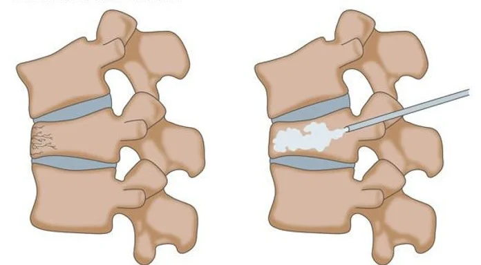 ΚΥΦΟΠΛΑΣΤΙΚΗ – ΣΠΟΝΔΥΛΟΠΛΑΣΤΙΚΗ - Neurosurgery Dr. Stoforou - Δρ ...